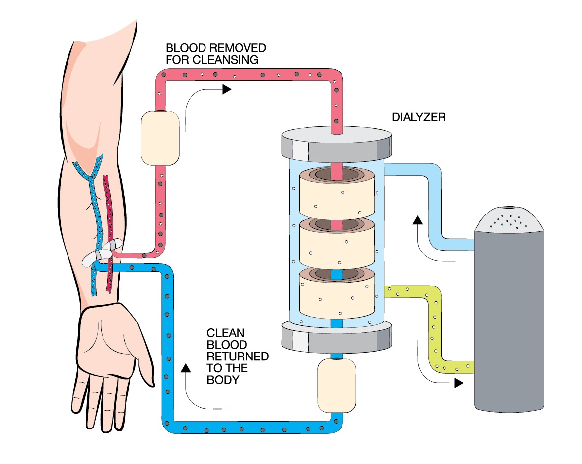 Mnemonic for Urgent Hemodialysis – The Book of OI
