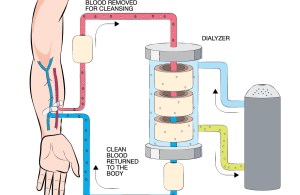 Mnemonic for Urgent Hemodialysis – The Book of OI